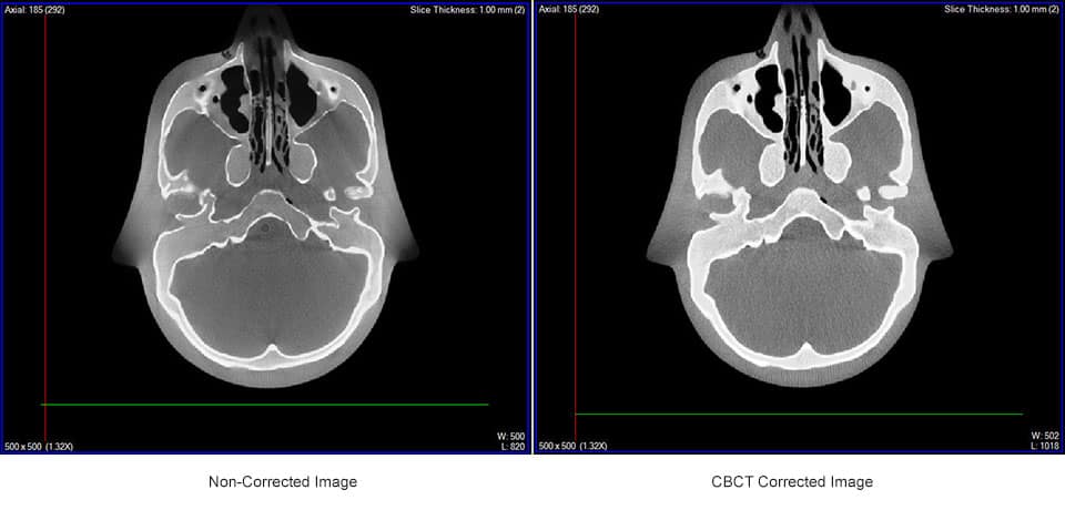 Cone Beam Computed Tomography (CBCT) Rivals Image Quality of Computed ...